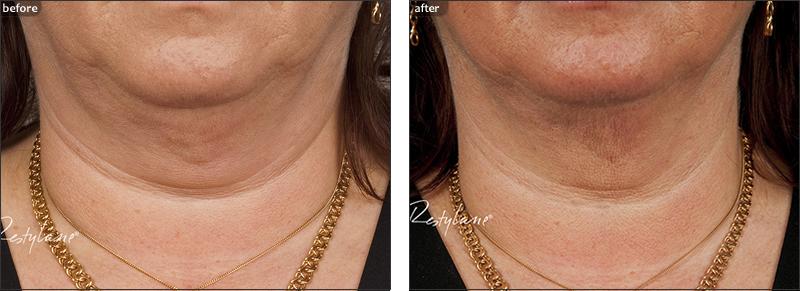 Dermal Fillers :: North Wales Aesthetics