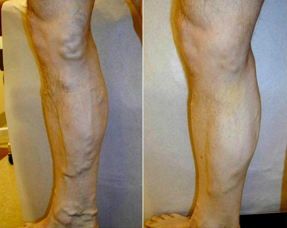 Leg Thread, Varicose And Reticular Vein Treatments :: North Wales ...